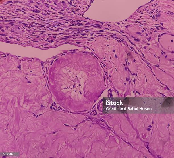 Uterus With Adnexa Cervix Show Chronic Inflamatory Cells Wall Show Secretory Phase In