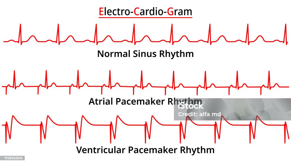 Set Of Ecg Common Abnormalities Atrial Vs Ventricular Pacemaker Rhythm ... Set Of Ecg Common Abnormalities Atrial Vs Ventricular Pacemaker Rhythm ...