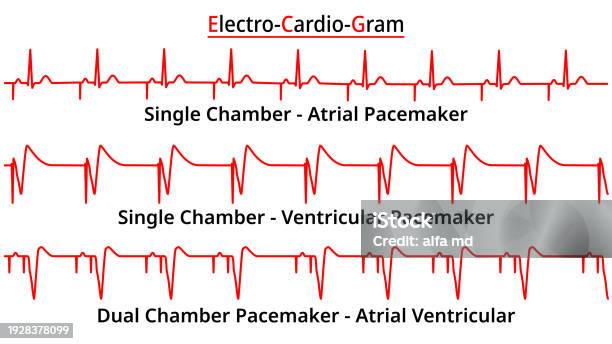 Set Of Ecg Common Abnormalities Single Vs Dual Chamber Pacemaker Atrial ... Set Of Ecg Common Abnormalities Single Vs Dual Chamber Pacemaker Atrial ...