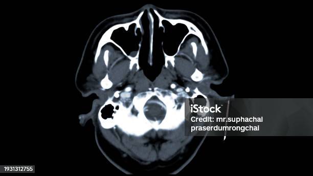 Ct Scan Of The Brain Axial View For Diagnosis Brain Tumor Stroke