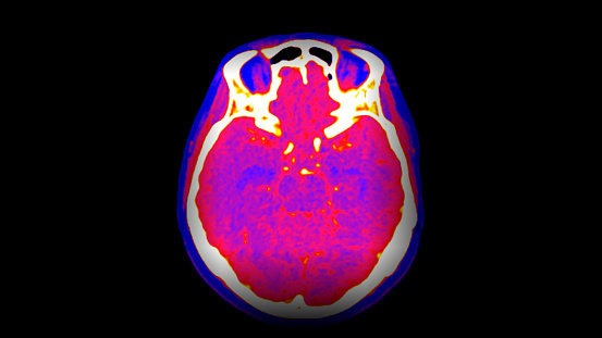 Ct Brain Perfusion Atau Gambar Ct Scan Dari Tampilan Aksial Otak Foto