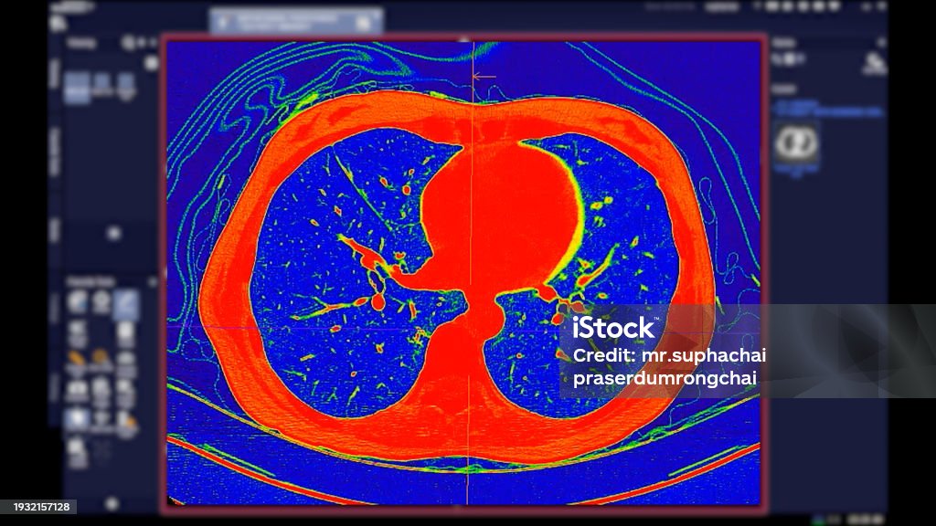 Ct Scan Tampilan Aksial Dada Dalam Mode Warna Untuk Diagnostik Emboli