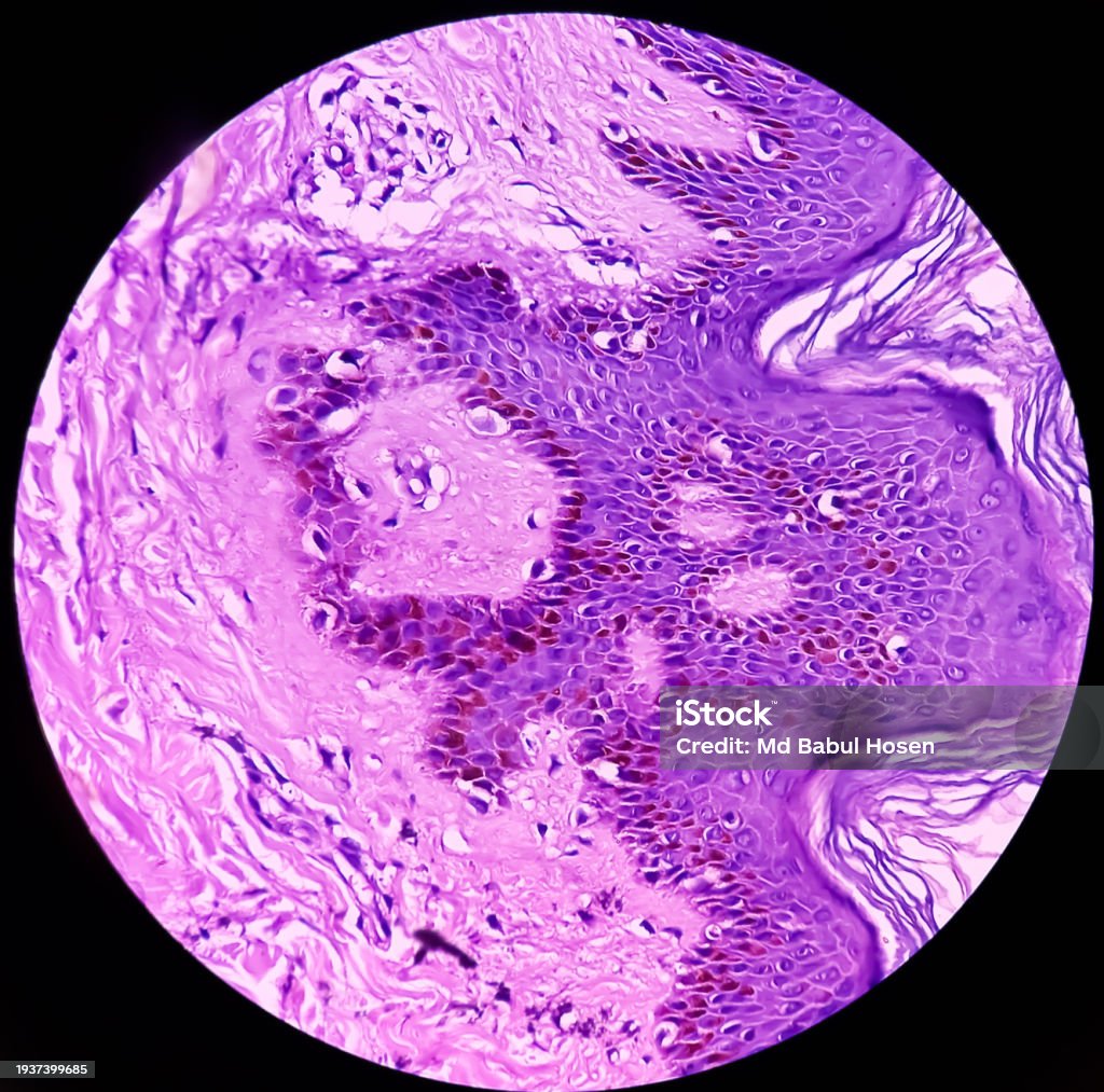 Lipoma On Loin Benign Growth Of Fatty Tissue Benign Neoplasm Adipocytes