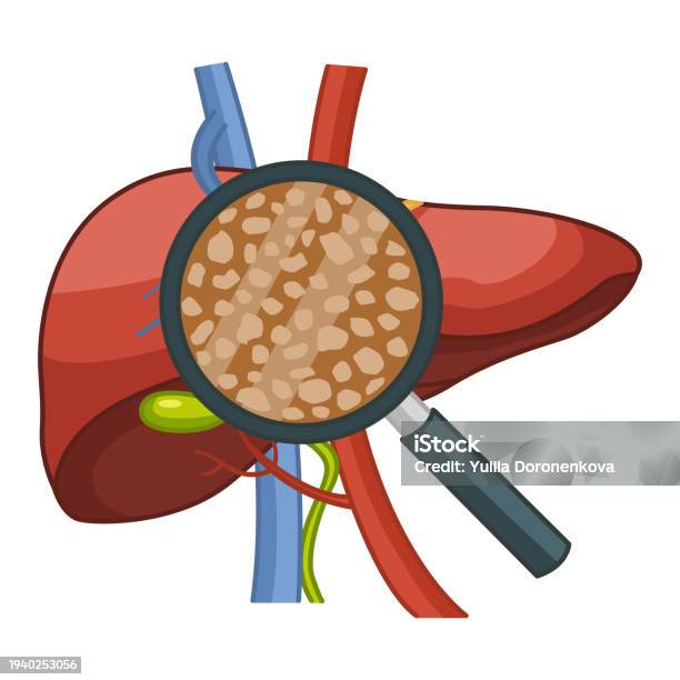 Ilustración De Enfermedad Hepática Cirrosis Hepática Bajo Lupa