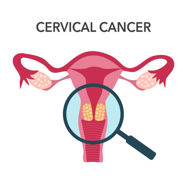 160 Cervical Carcinoma Stock Illustrations Royalty Free Vector