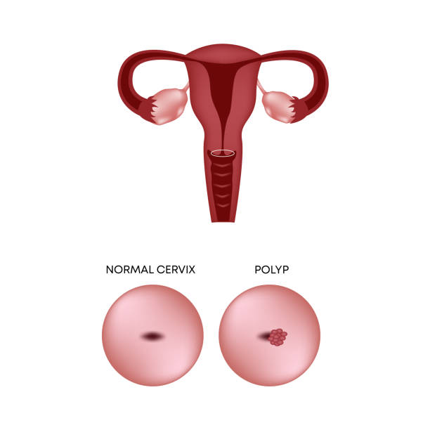 90 Cervical Polyps Stock Illustrations Royalty Free Vector Graphics