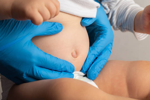 330 Hernia Umbilical Fotos De Stock Imagens E Fotos Royalty Free Istock
