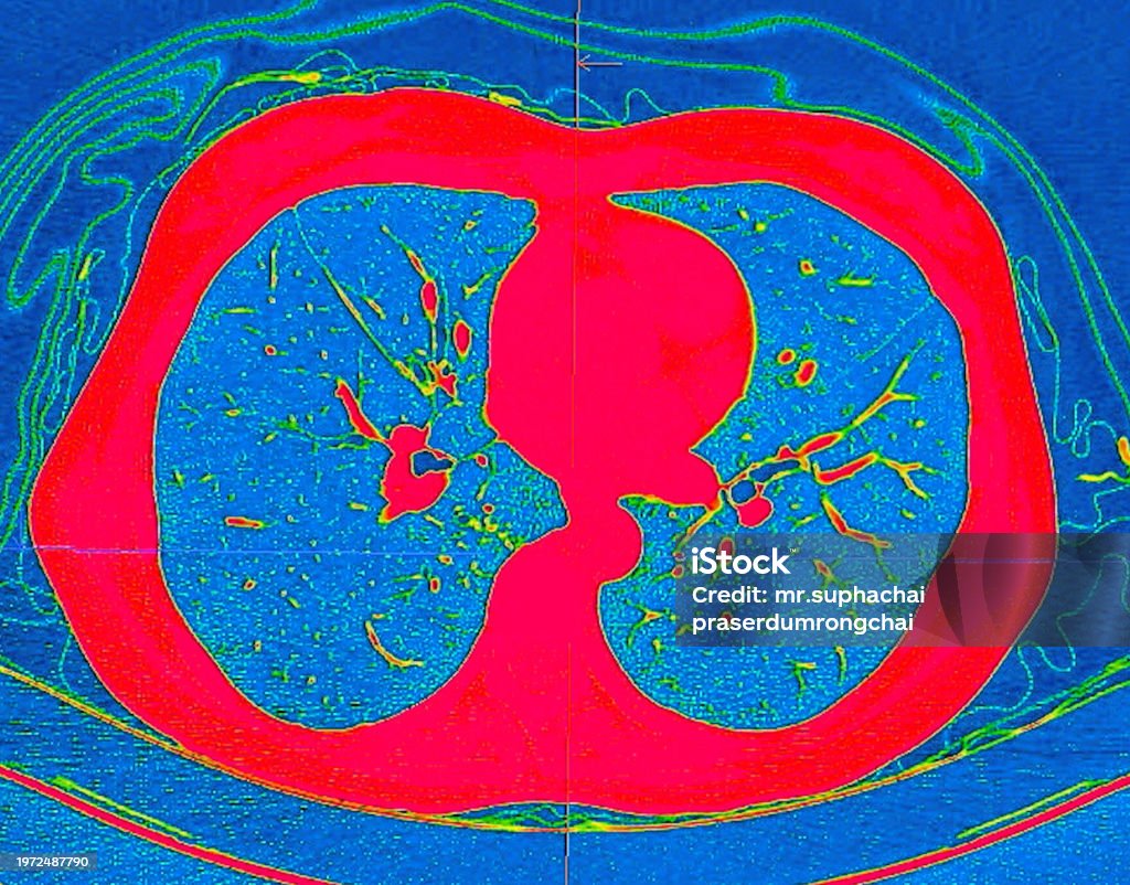 Ct Scan Of Chest Axial View In Color Mode For Diagnostic Pulmonary