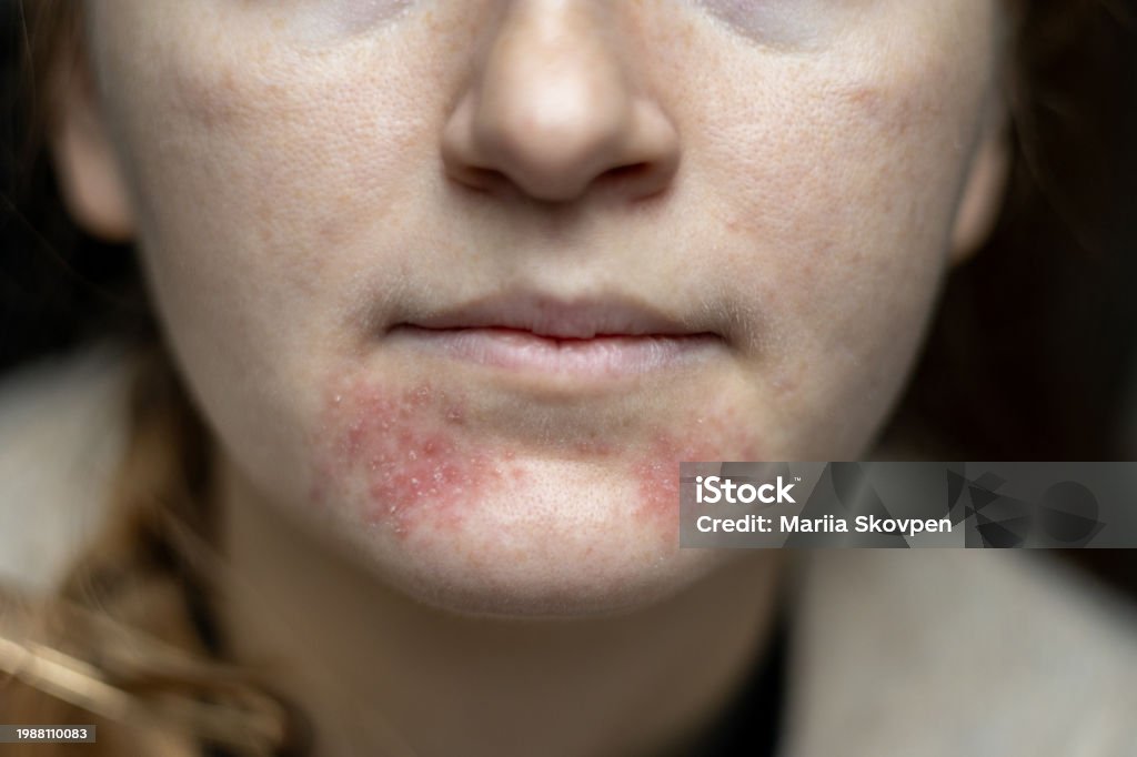 Perioral Dermatitis On Woman Face Closeup Dermatitis On Skin Ill
