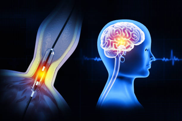 50+ Neuro Interventional Radiology Stock Photos, Pictures & Royalty ... 50+ Neuro Interventional Radiology Stock Photos, Pictures & Royalty ...