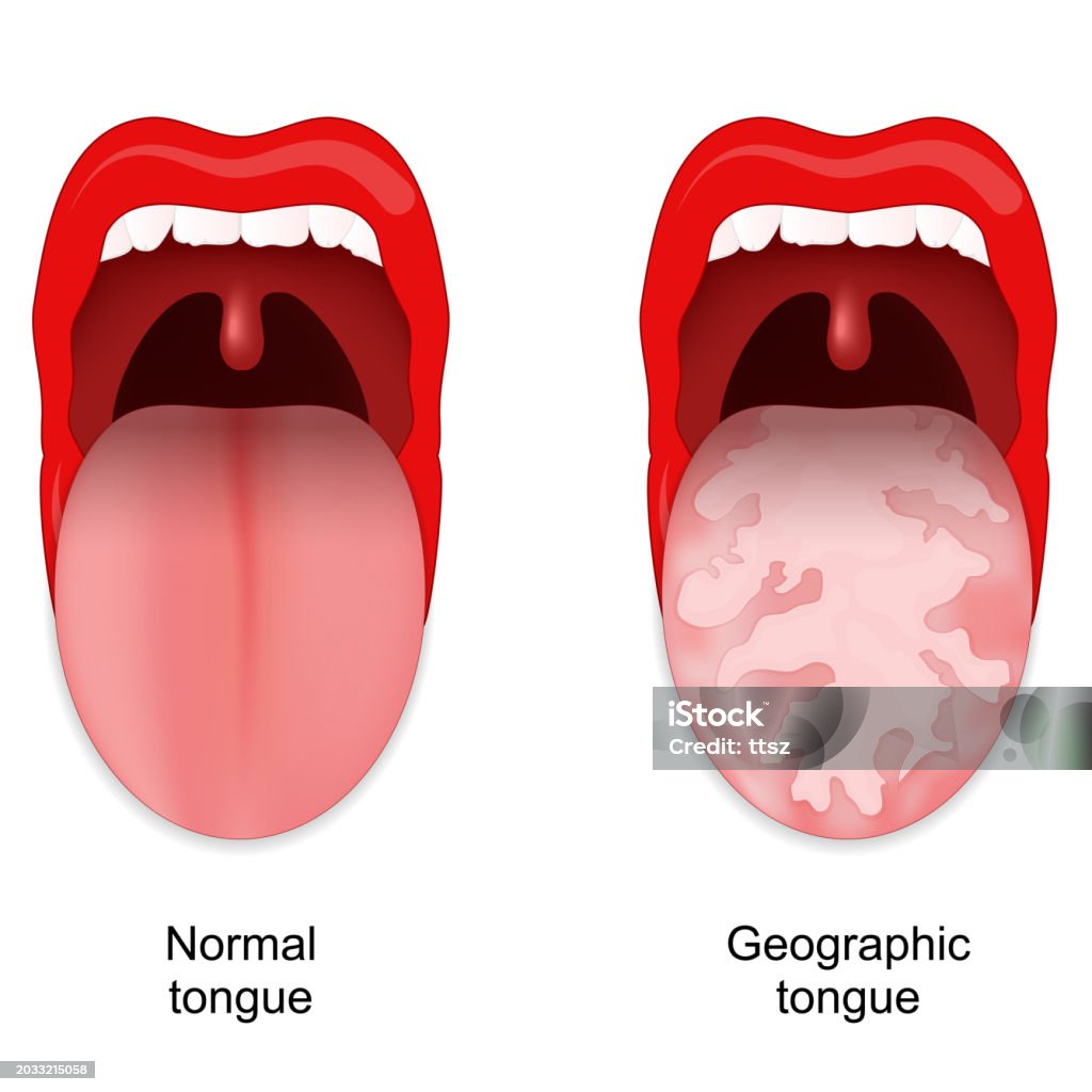 Geographic Tongue Benign Migratory Glossitis Stock Illustration Download Image Now Physical