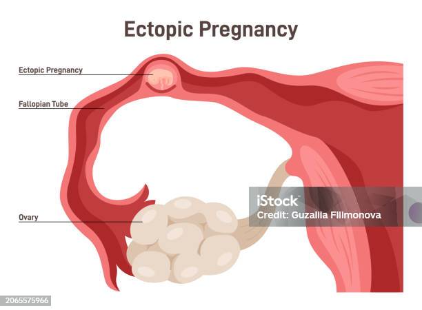 Ilustración De Embarazo Ectópico Ilustración Médica Del Embarazo