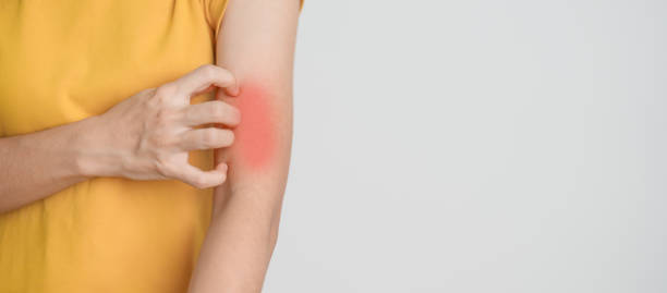 130 Lupus Rash Fotografías De Stock Fotos E Imágenes Libres De
