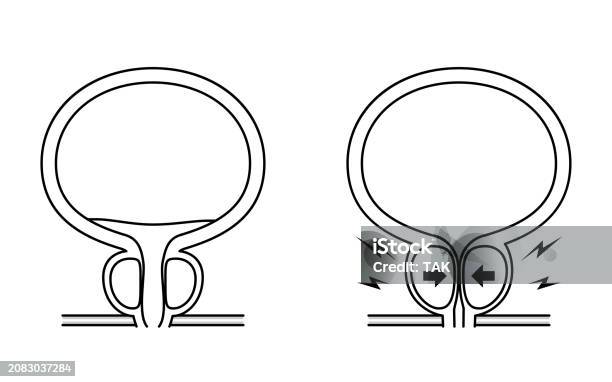 Medical Illustration Of Benign Prostatic Hyperplasia Normal Vs Enlarged Prostate Stock