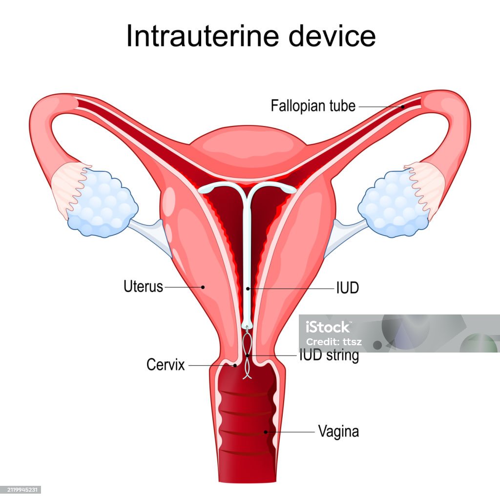 Intrauterine Device Or Coil Uterus With Iucd Or Icd Inside Stock