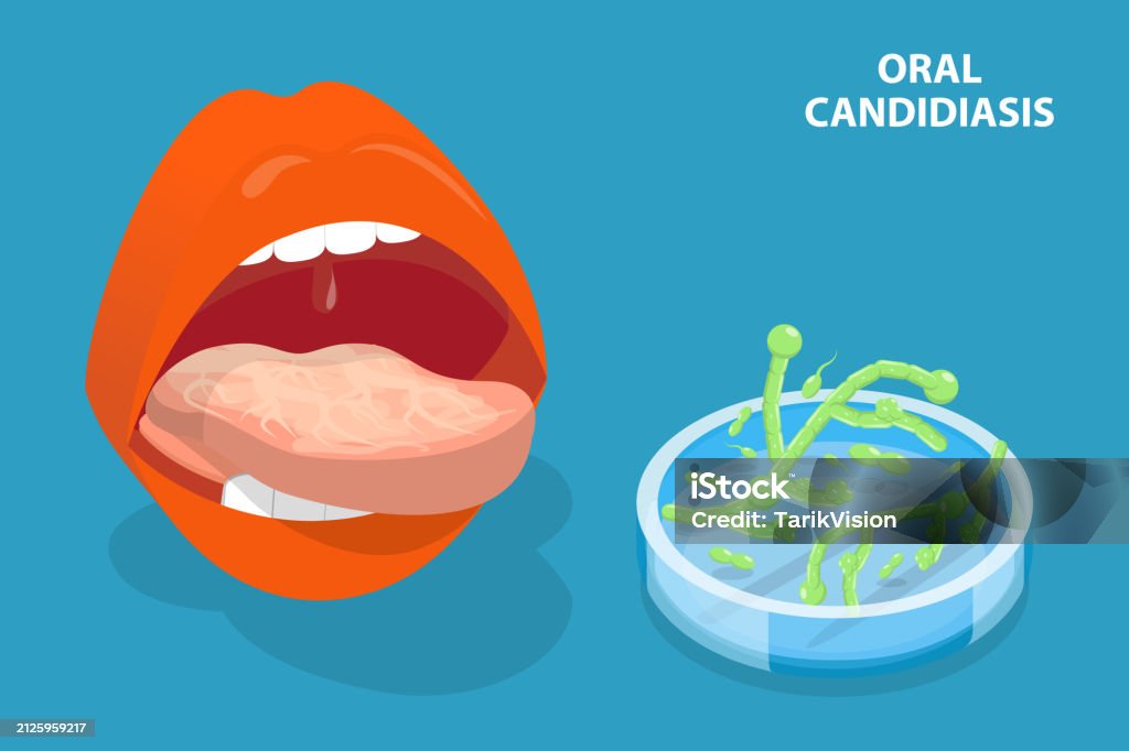 3d Isometric Flat Vector Conceptual Illustration Of Oral Candidiasis