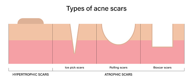 Types Of Acne Scars Vector Acne Scar Analysis Stock Illustration Download Image Now Acne