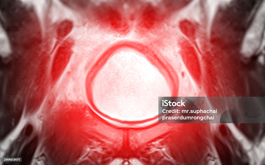 Mri Of The Prostate Gland Reveals Focal Abnormal Si Lesion At Left Pzpl