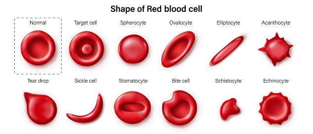 Variasi Bentuk Morfologi Sel Darah Merah Eritrosit Normal Dan Abnormal ... Variasi Bentuk Morfologi Sel Darah Merah Eritrosit Normal Dan Abnormal ...