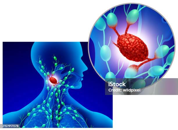 Swollen Lymph Node Stock Photo - Download Image Now - Lymph Node ... Swollen Lymph Node Stock Photo - Download Image Now - Lymph Node ...
