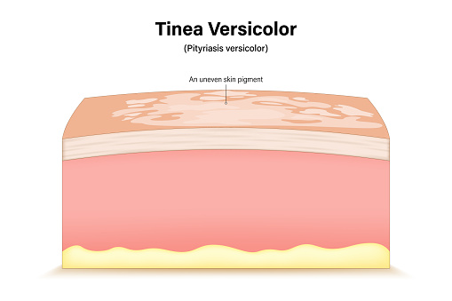 Tinea Versicolor Pityriasis Versicolor Infeksi Kulit Jamur Penampang