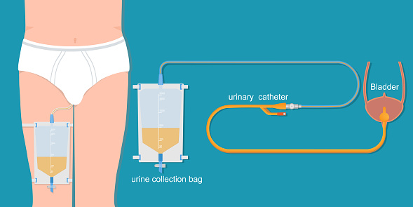 Urinary Catheter In The Male Body With Urinary Leg Bag Stock Illustration Download Image Now