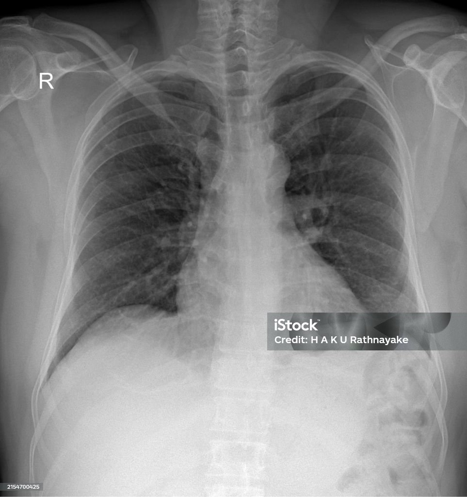 From Pixels To Pathology Unveiling Insights With Chest Xray Analysis