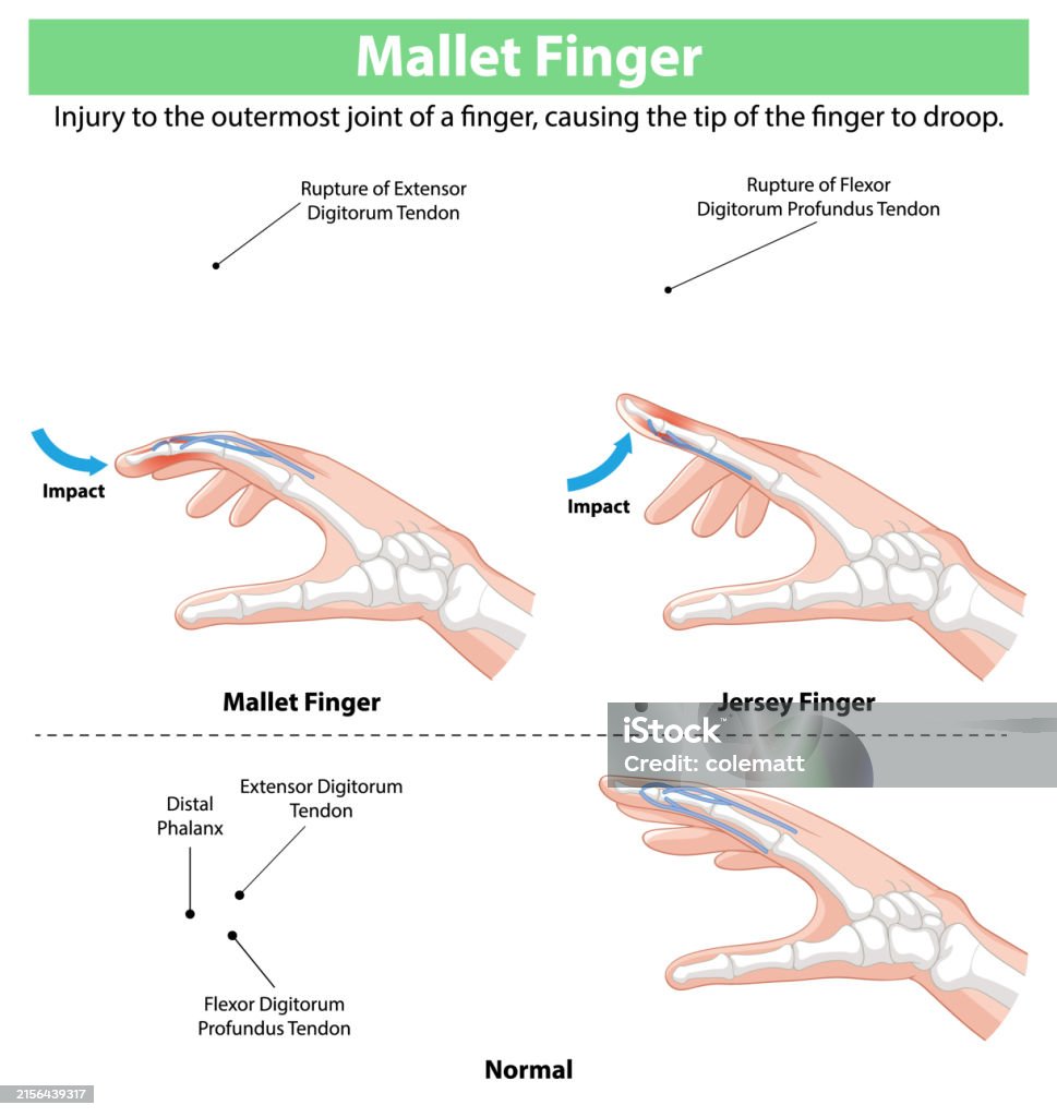 Diagram Showing Mallet And Jersey Finger Injuries Stock Illustration Download Image Now
