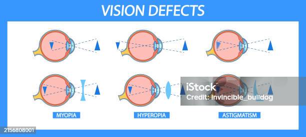 Informative Chart Detailing Myopia Hyperopia And Astigmatism In Eye ... Informative Chart Detailing Myopia Hyperopia And Astigmatism In Eye ...