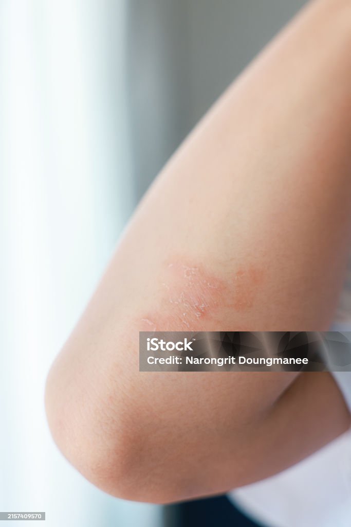 Closeup Of Skin Asian Woman With Acute Psoriasis On Her Elbows Autoimmune Incurable