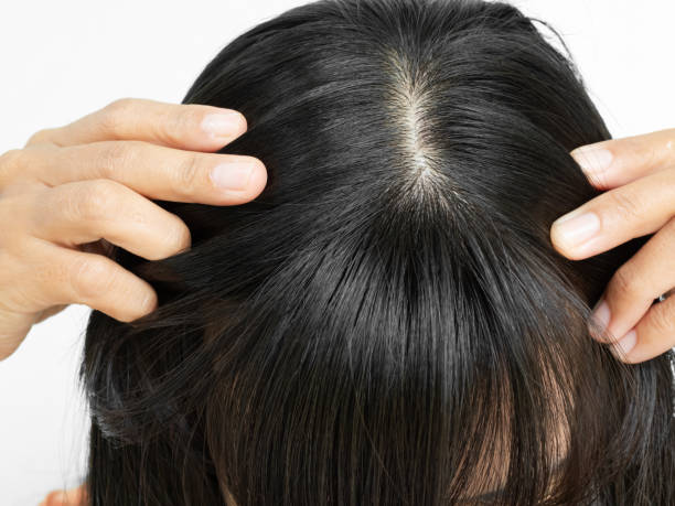 300 Skin Cancer On Scalp Fotografías De Stock Fotos E Imágenes Libres De Derechos Istock