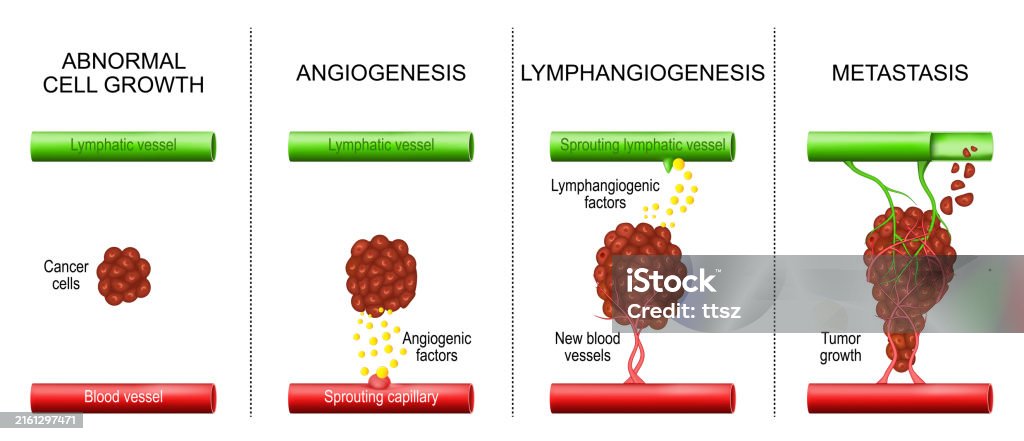 Cancer Tumor Development Angiogenesis And Metastasis Stock Illustration ... Cancer Tumor Development Angiogenesis And Metastasis Stock Illustration ...