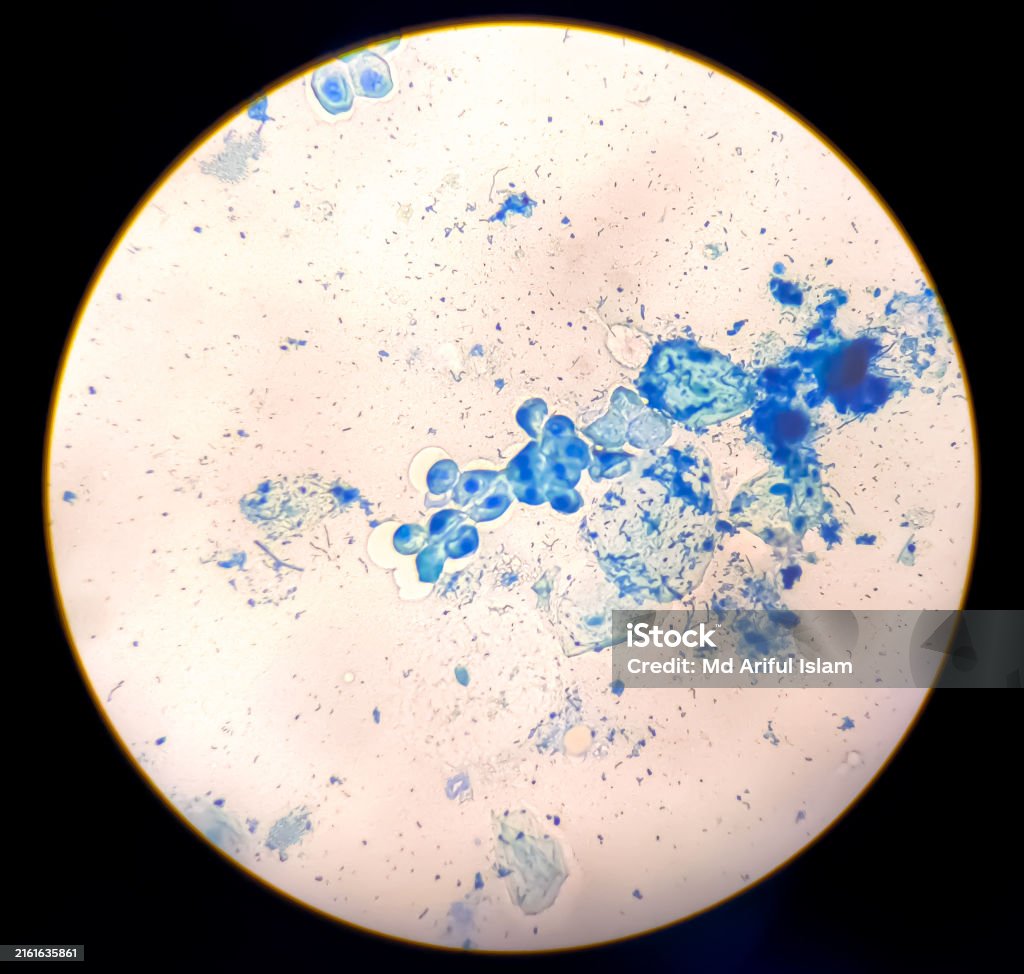 Malignant Cells With Multiple Nuclei And Prominent Nucleoli Micrograph