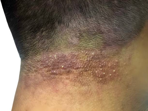 500 Dermatitis Seboroik Foto Foto Foto Stok Potret And Gambar Bebas