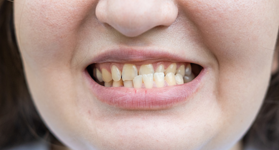 Patient With Dislocated Jaw And Malocclusion Temporomandibular Joint