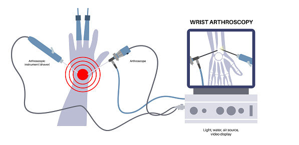 Wrist Arthroscopy Surgery Stock Illustration Download Image Now Arm