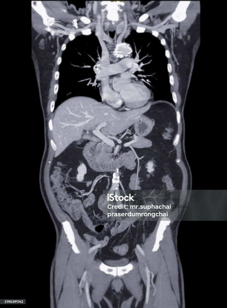 Cta Of Aorta And Major Branches A Comprehensive Cta Scan Showing The ... Cta Of Aorta And Major Branches A Comprehensive Cta Scan Showing The ...