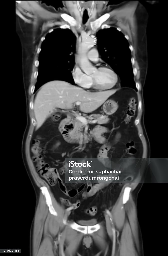 Cta Of Aorta And Major Branches A Comprehensive Cta Scan Showing The ... Cta Of Aorta And Major Branches A Comprehensive Cta Scan Showing The ...