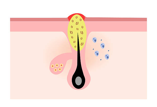 Acne pus Clipart Vector PNG , SVG, EPS, PSD, AI