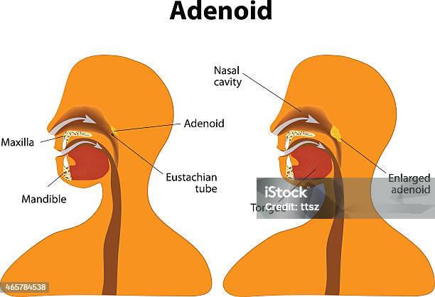Adenoid Normal And Enlarged Adenoid Stock Illustration - Download Image ... Adenoid Normal And Enlarged Adenoid Stock Illustration - Download Image ...