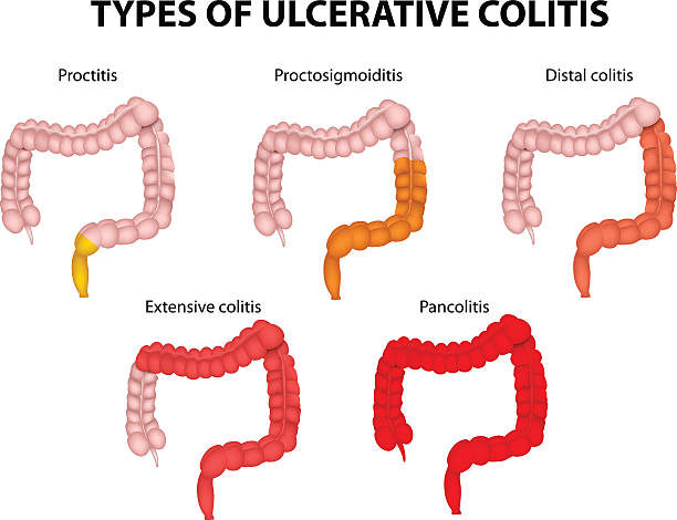 1100 Colitis Stock Illustrations Royalty Free Vector Graphics And Clip