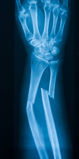 Broken Arm Pictures | Download Free Images on Unsplash