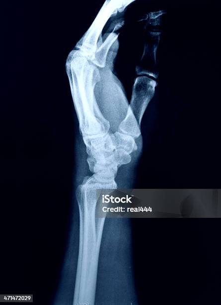 Imagen De Rayos X De Manos Foto de stock y más banco de imágenes de ... Imagen De Rayos X De Manos Foto de stock y más banco de imágenes de ...