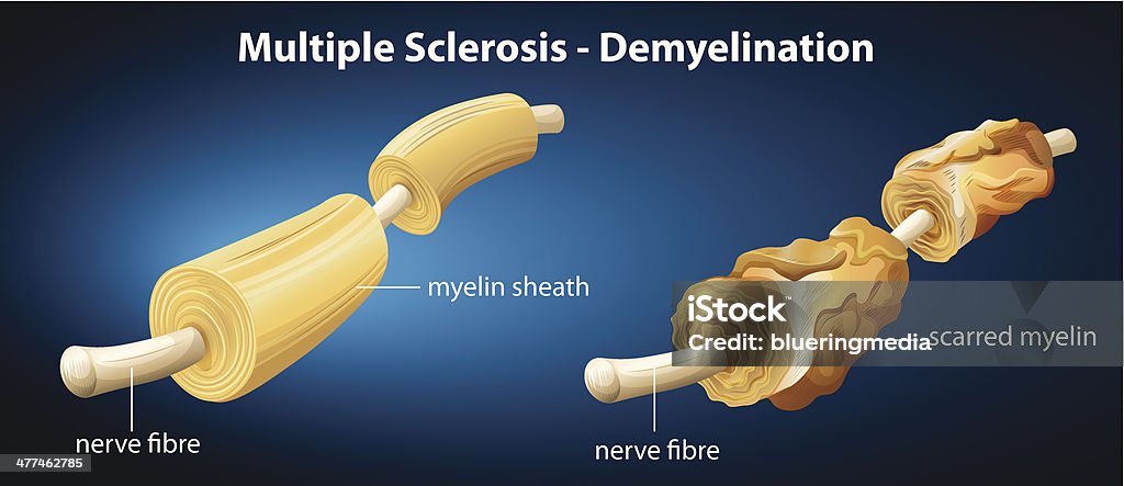 Multiple Sclerosis Stock Illustration - Download Image Now - Myelin ... Multiple Sclerosis Stock Illustration - Download Image Now - Myelin ...