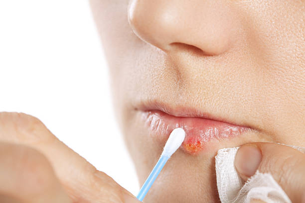 810 Herpes En El Cuerpo Humano Fotografías De Stock Fotos E Imágenes
