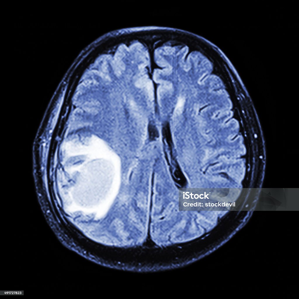 Mri Del Cerebro Foto De Stock Y Más Banco De Imágenes De Cáncer De Cerebro Cáncer De Cerebro