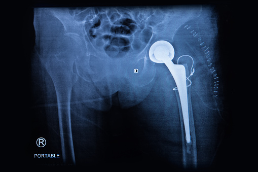 Xray Endoprosthesis Pinggul Pada Wanita Tua Foto Stok - Unduh Gambar ... Xray Endoprosthesis Pinggul Pada Wanita Tua Foto Stok - Unduh Gambar ...