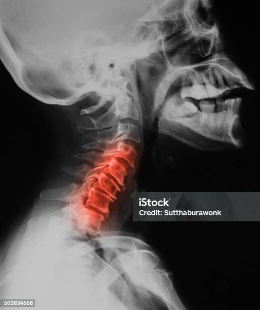 X선 영상을 자궁경관 척추 레터럴 볼 수 있습니다 엑스레이 이미지에 대한 스톡 사진 및 기타 이미지 엑스레이 이미지 여자