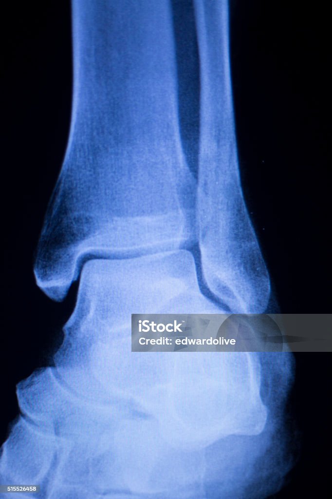 Shin Leg Ankle Injury Xray Scan Stock Photo - Download Image Now ... Shin Leg Ankle Injury Xray Scan Stock Photo - Download Image Now ...
