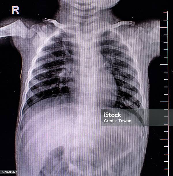 Gambar Xray Dada Manusia Untuk Diagnosis Medis Foto Stok Unduh Gambar